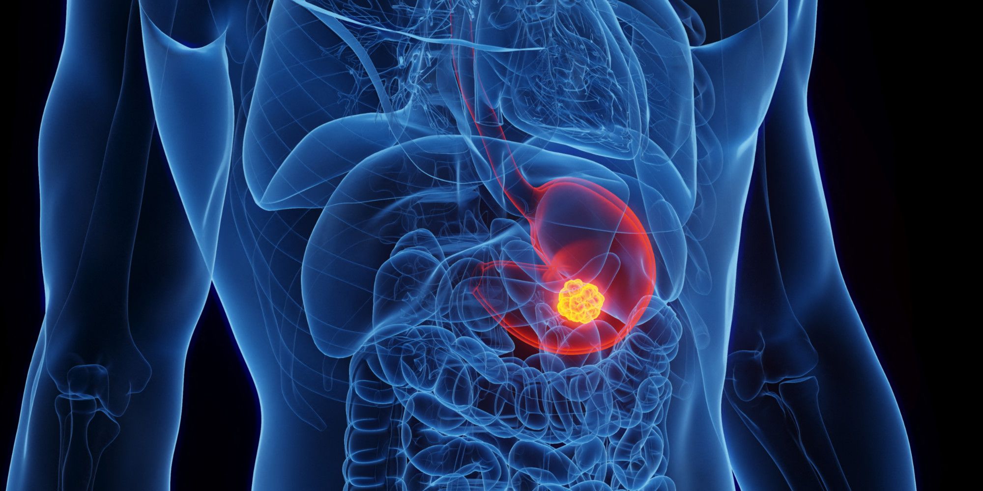 H. pylori: A Rising Threat to Global Stomach Cancer Rates? – Archyde