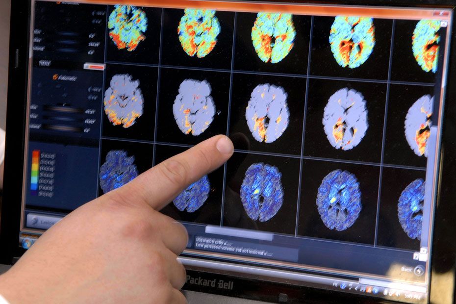 Journée mondiale de l’AVC : en France, 160.000 personnes touchées ...